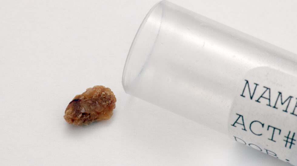 Kidney Stone Treatment in Northern Virginia | Nephrolithiasis Doctors